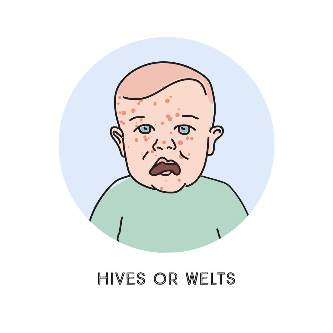 How to recognise an allergic reaction - Prevent Allergies