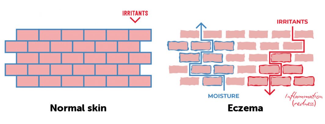 What is eczema? - Prevent Allergies